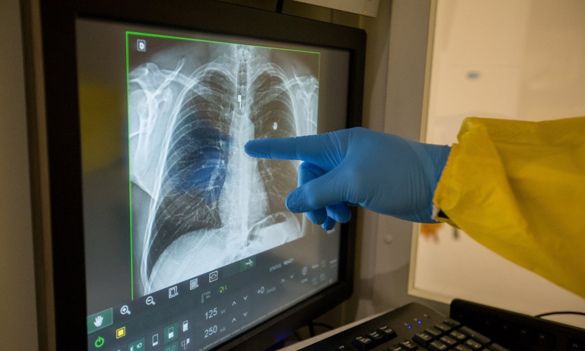 Liječnje KOPB-a transplantacijom vlastitih plućnih stanica? - tportal