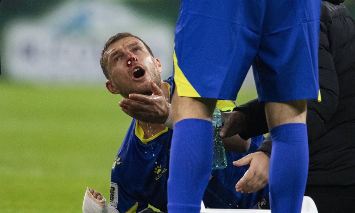 Edin Džeko objavio kako mu izgleda lice nakon brutalnog udarca kopačkom u glavu - tportal