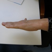 Kako prepoznati simptome i spriječiti bolesti ruke i šake - tportal