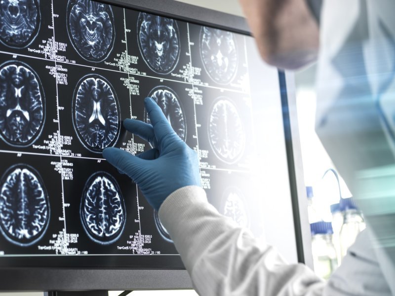 Pomak u liječenju Alzheimera i Parkinsona: Znanstvenici napravili ...