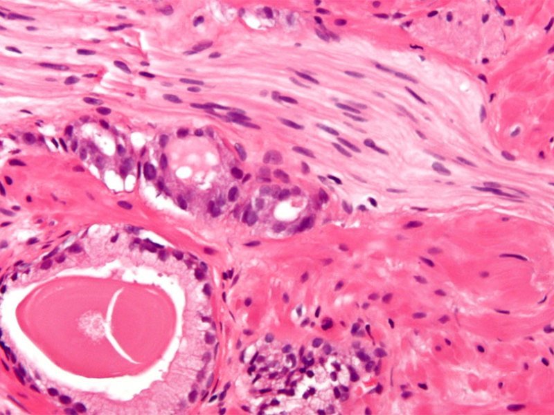 Rak prostate postao gotovo 100% izlječiv - tportal