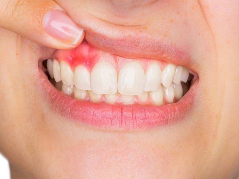 Bolest desni – patite li od parodontoze? - tportal